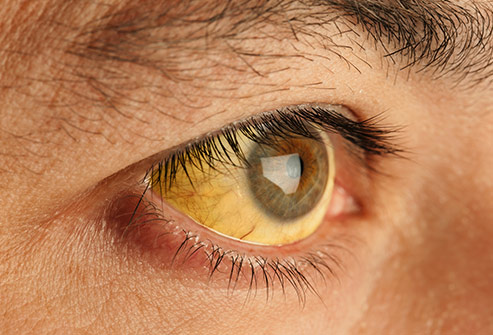 Yellow Fever – Kingdom of the Netherlands – Quarantine Unit